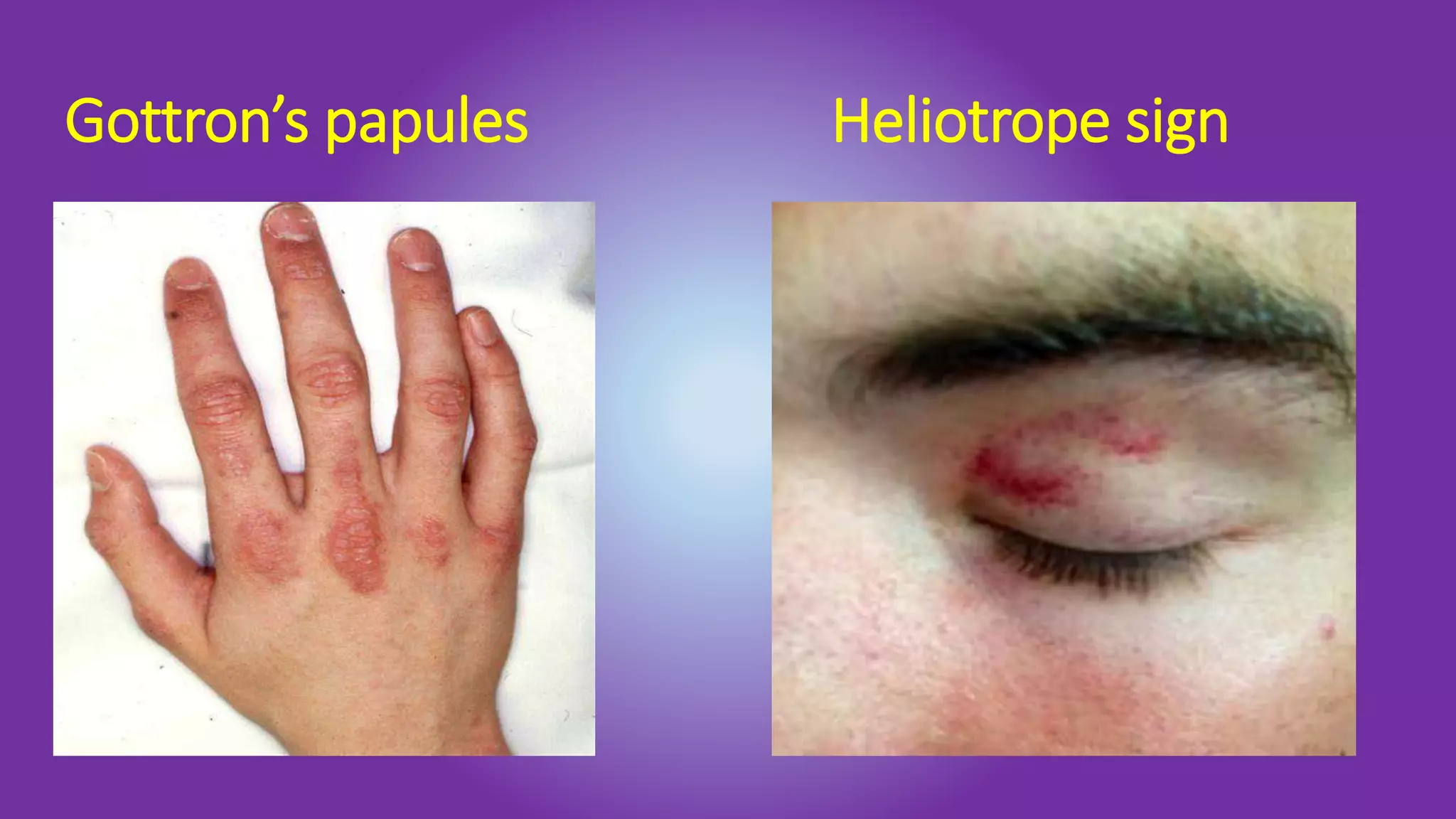 Connective Tissue Disorders.pptx