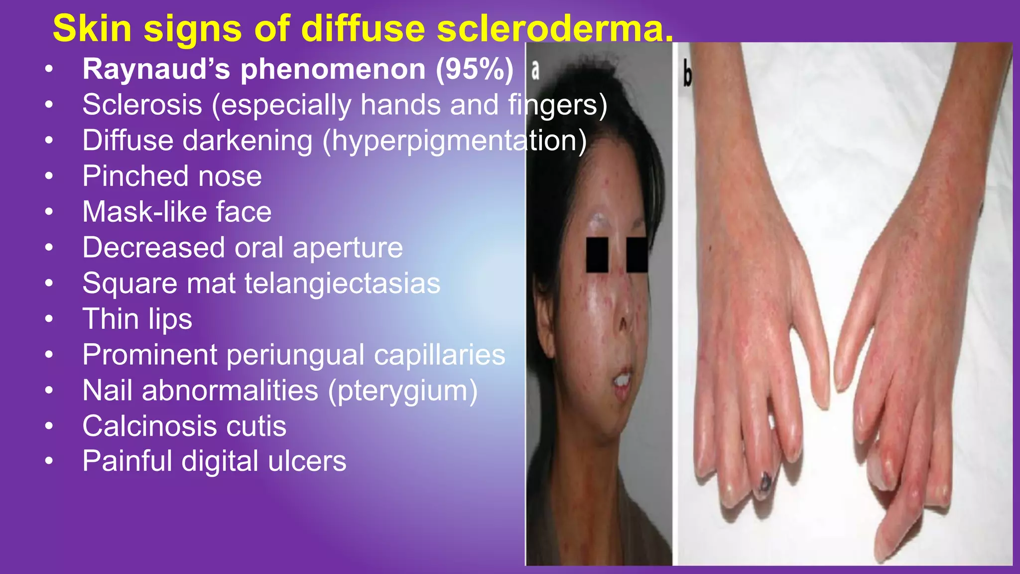 Connective Tissue Disorders.pptx