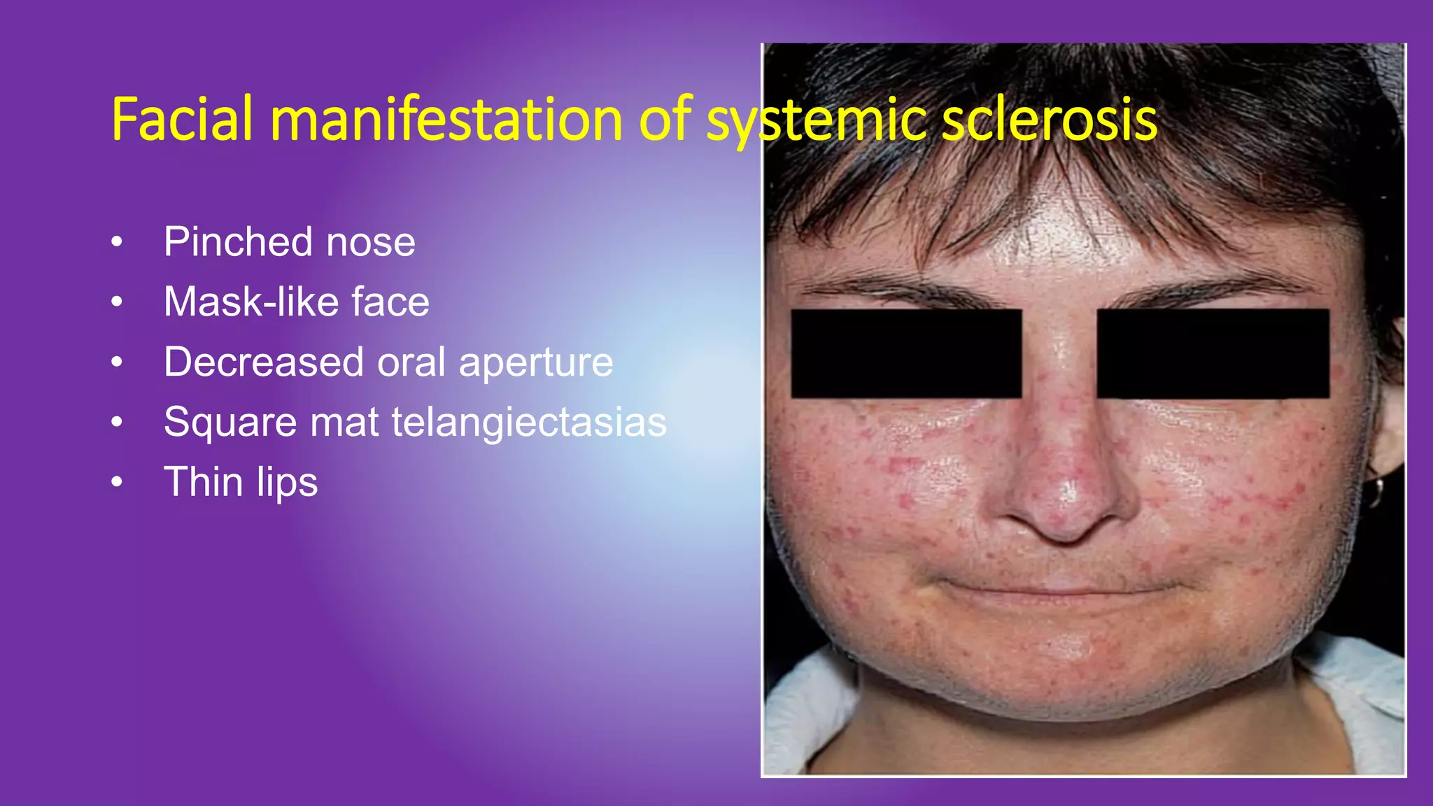 Connective Tissue Disorders.pptx