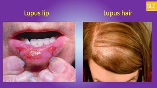 Connective Tissue Disorders.pptx