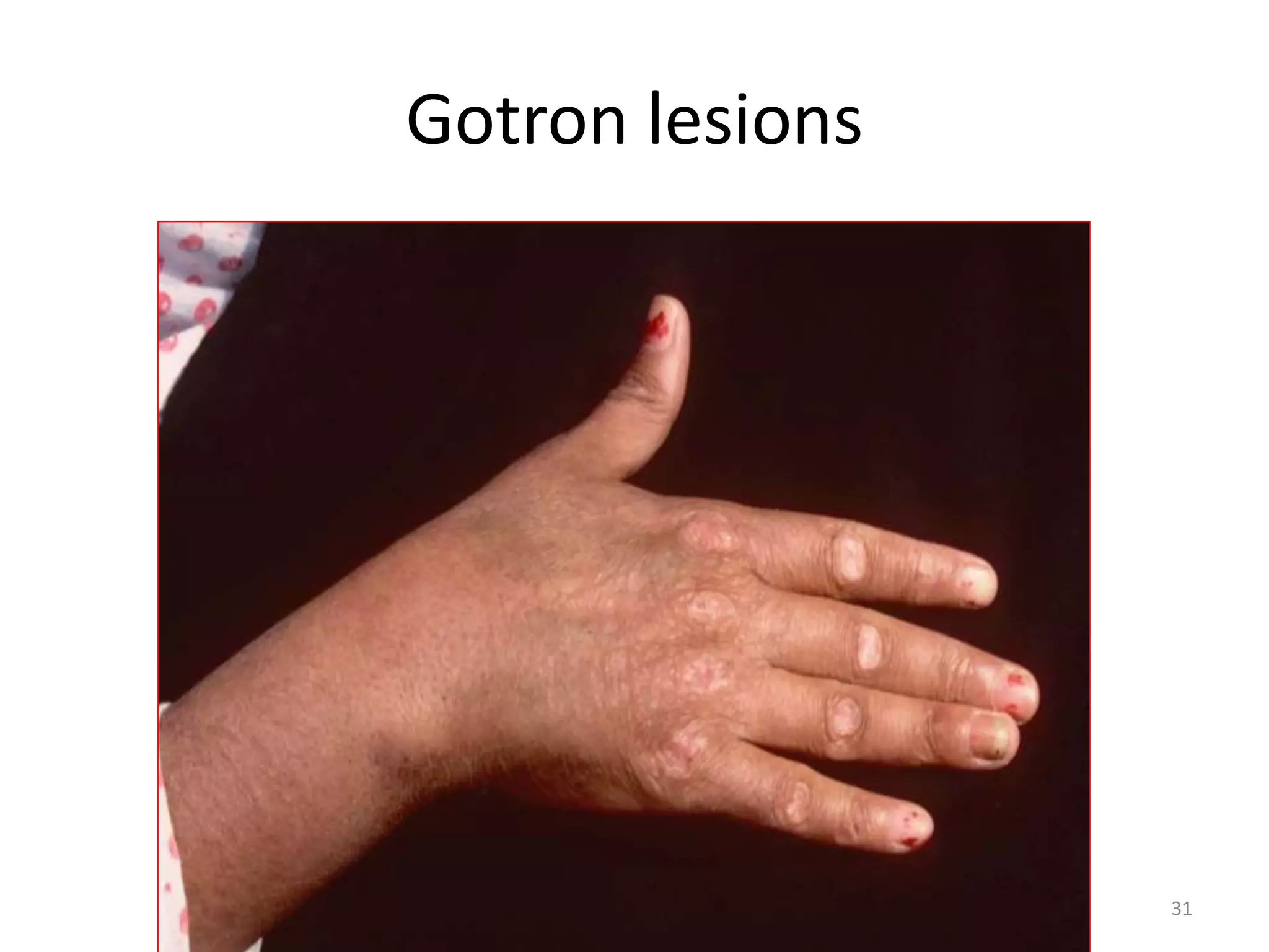 Connective tissue disorders (CTDs) | PPTX