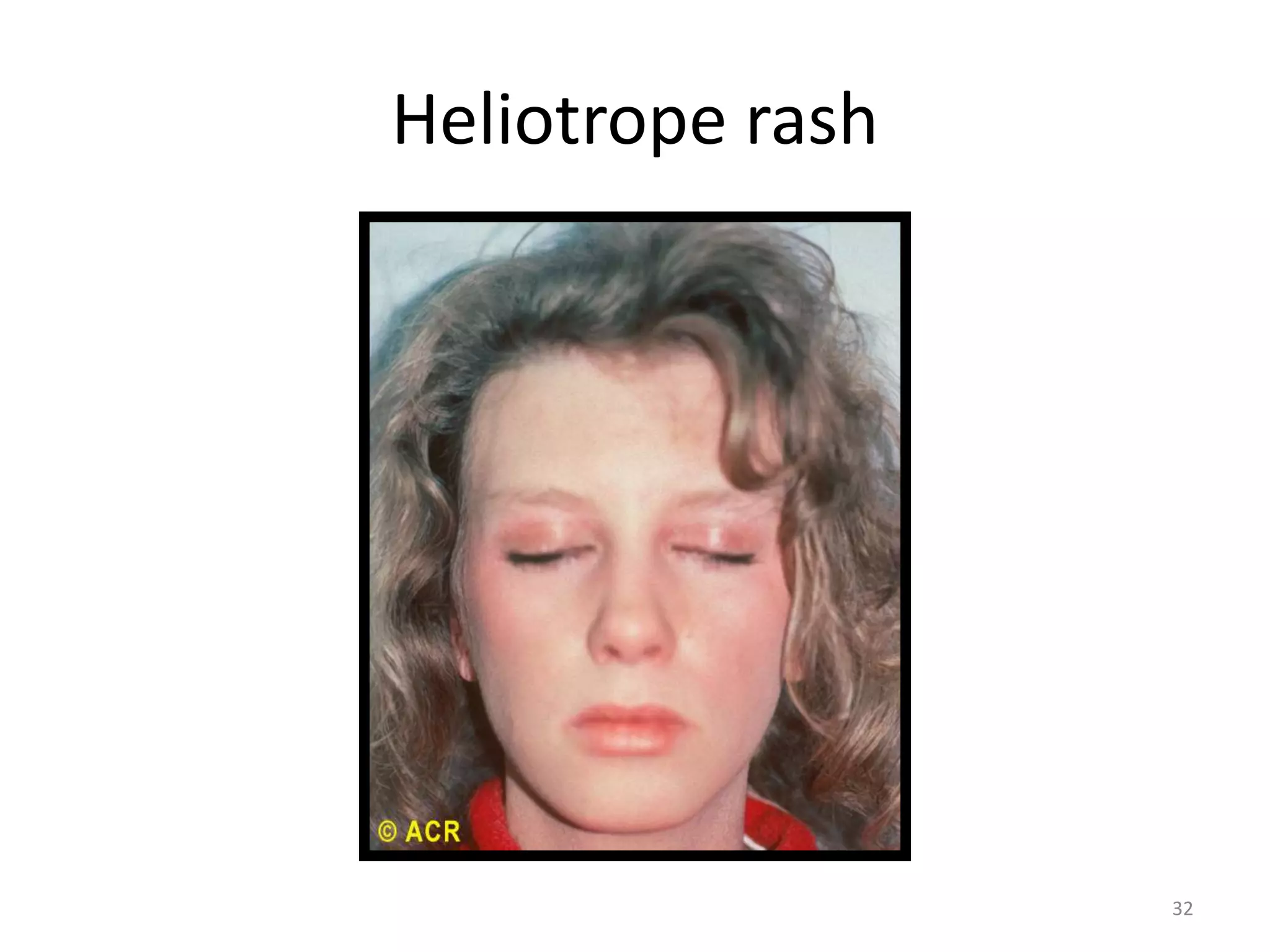 Connective tissue disorders (CTDs) | PPTX