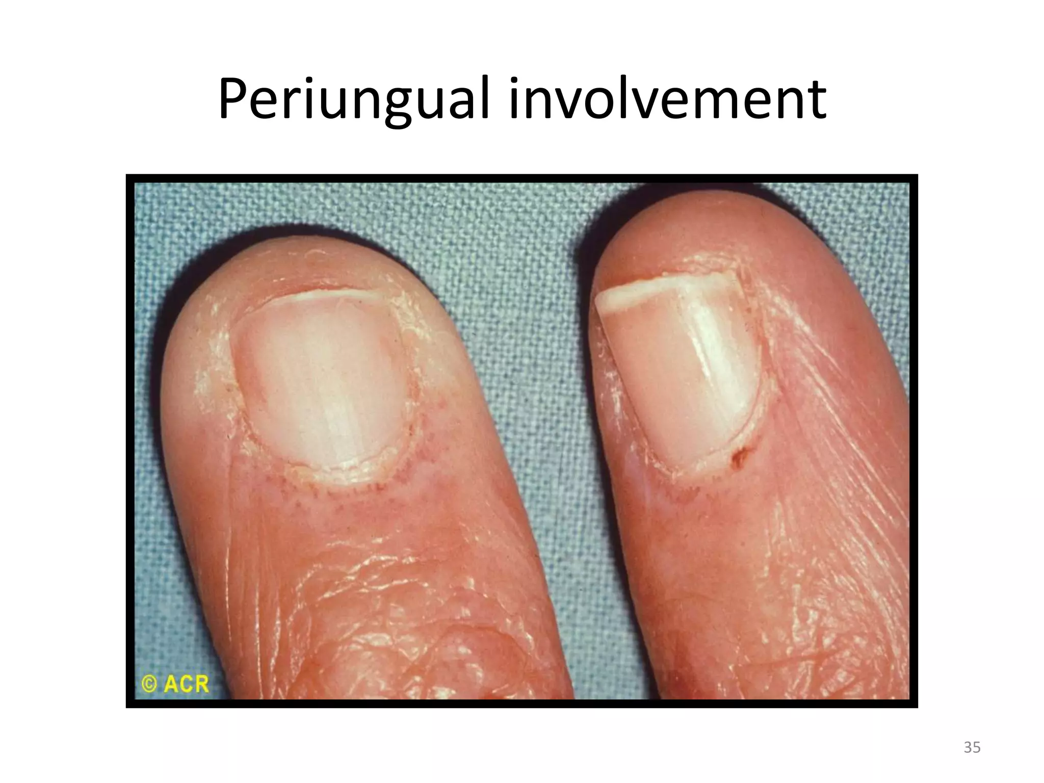 Connective tissue disorders (CTDs) | PPTX