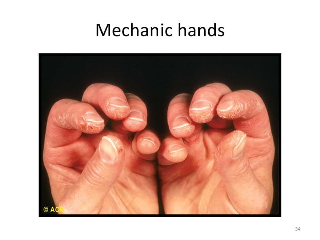 Connective tissue disorders (CTDs) | PPTX | Skin and Dermatology ...