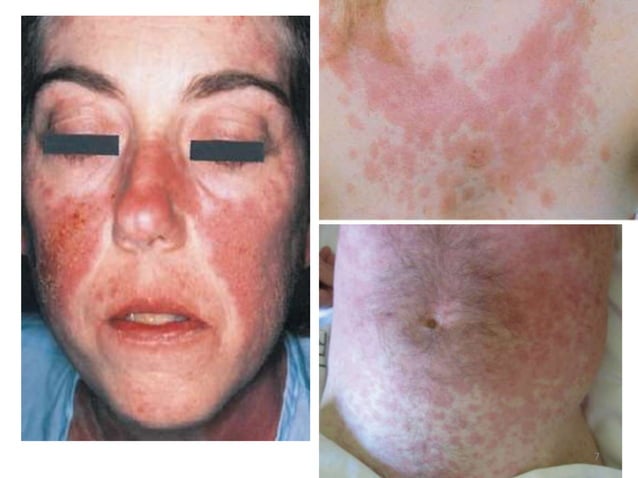 Connective tissue disorders (CTDs) | PPTX | Skin and Dermatology ...