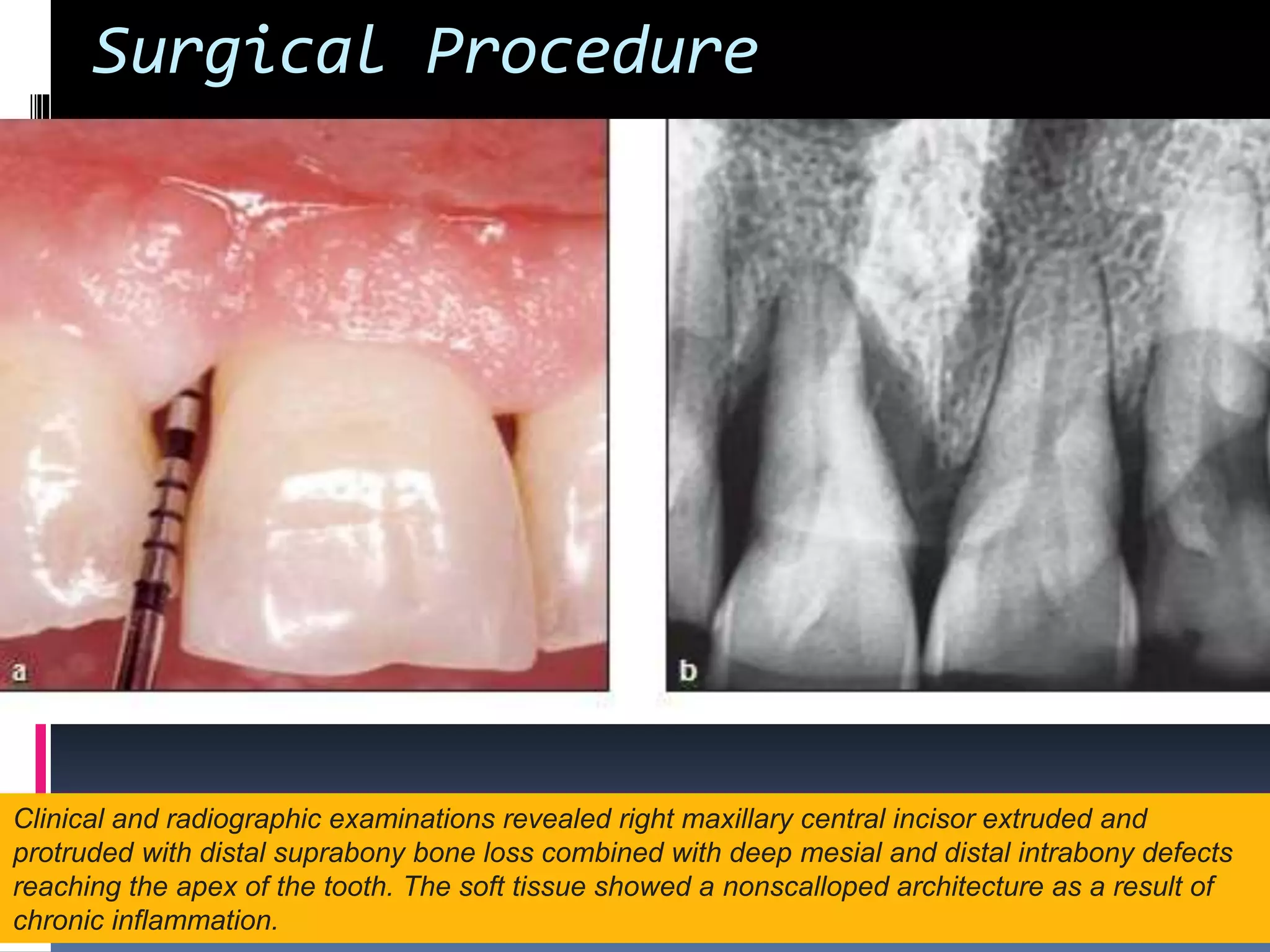 Connective tissue grafts | PPTX Connective tissue grafts | PPTX