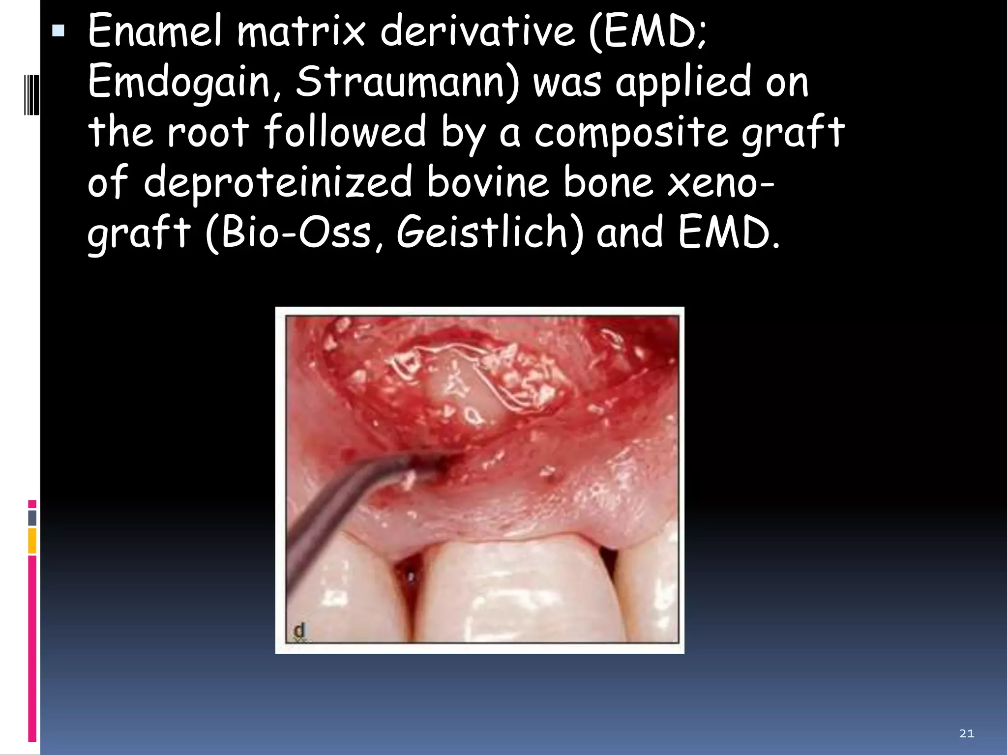 Connective Tissue Grafts Pptx