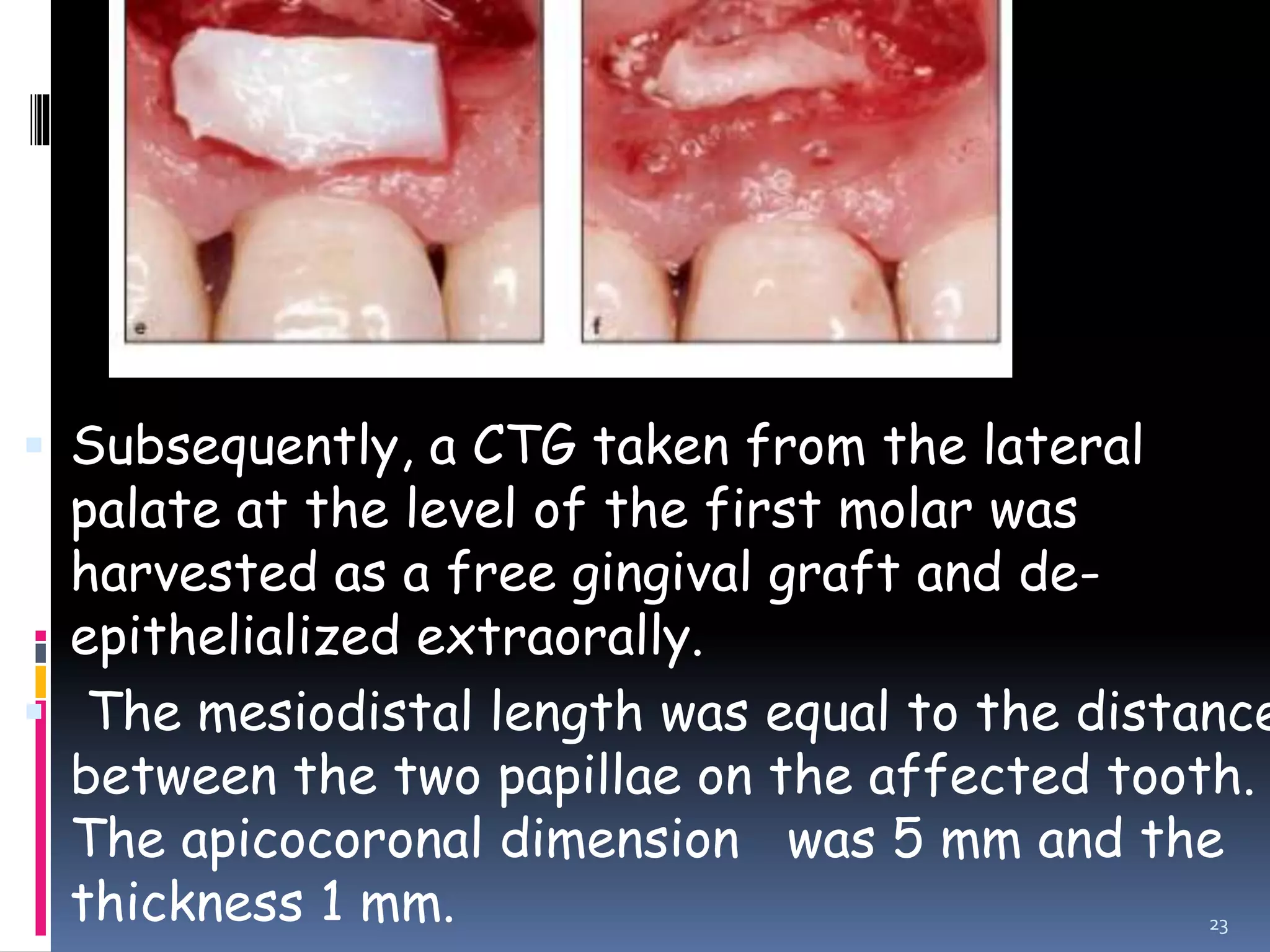 Connective tissue grafts | PPTX