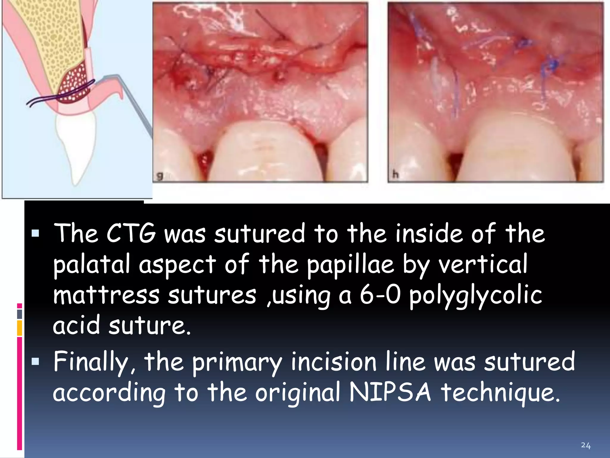 Connective tissue grafts | PPTX
