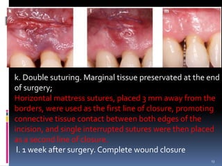 Connective tissue grafts | PPTX