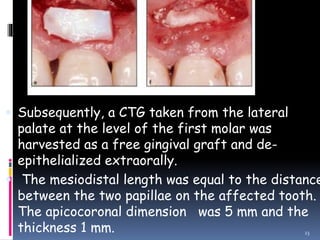 Connective tissue grafts | PPTX