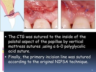 Connective tissue grafts | PPTX