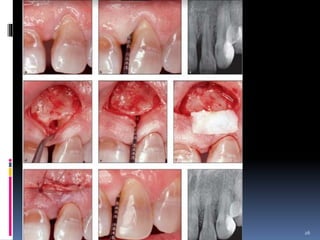 Connective Tissue Grafts Pptx