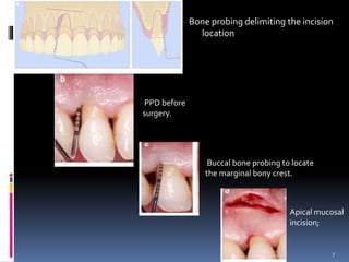 Connective tissue grafts | PPTX