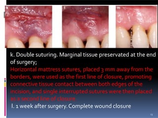 connectivetissuegraftswithnonincisedpapillaesurgicalapproachforperiodon ...