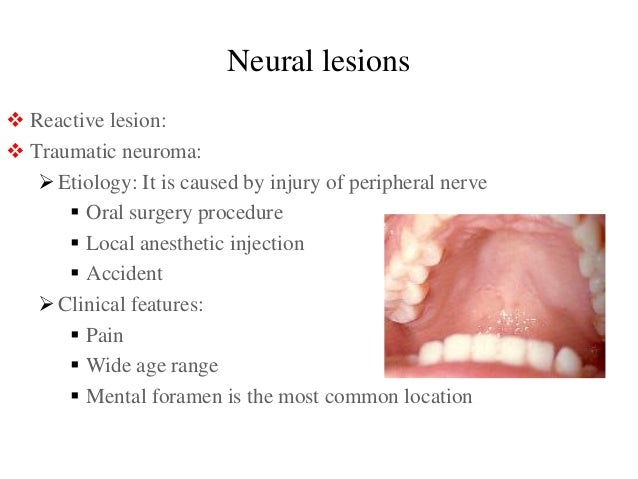 Traumatic Neuroma In Mouth Diagnosis And Treatment For Breakthrough