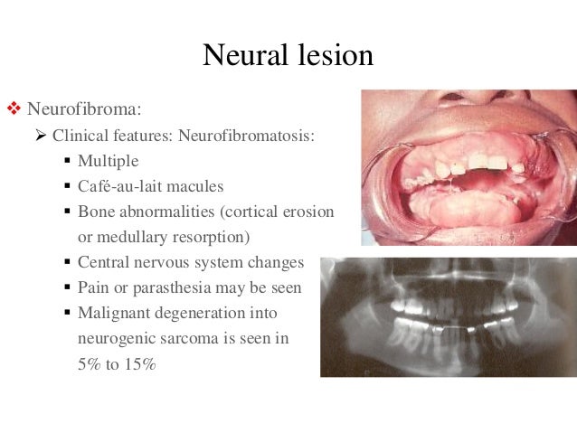 Connective tissue lesions