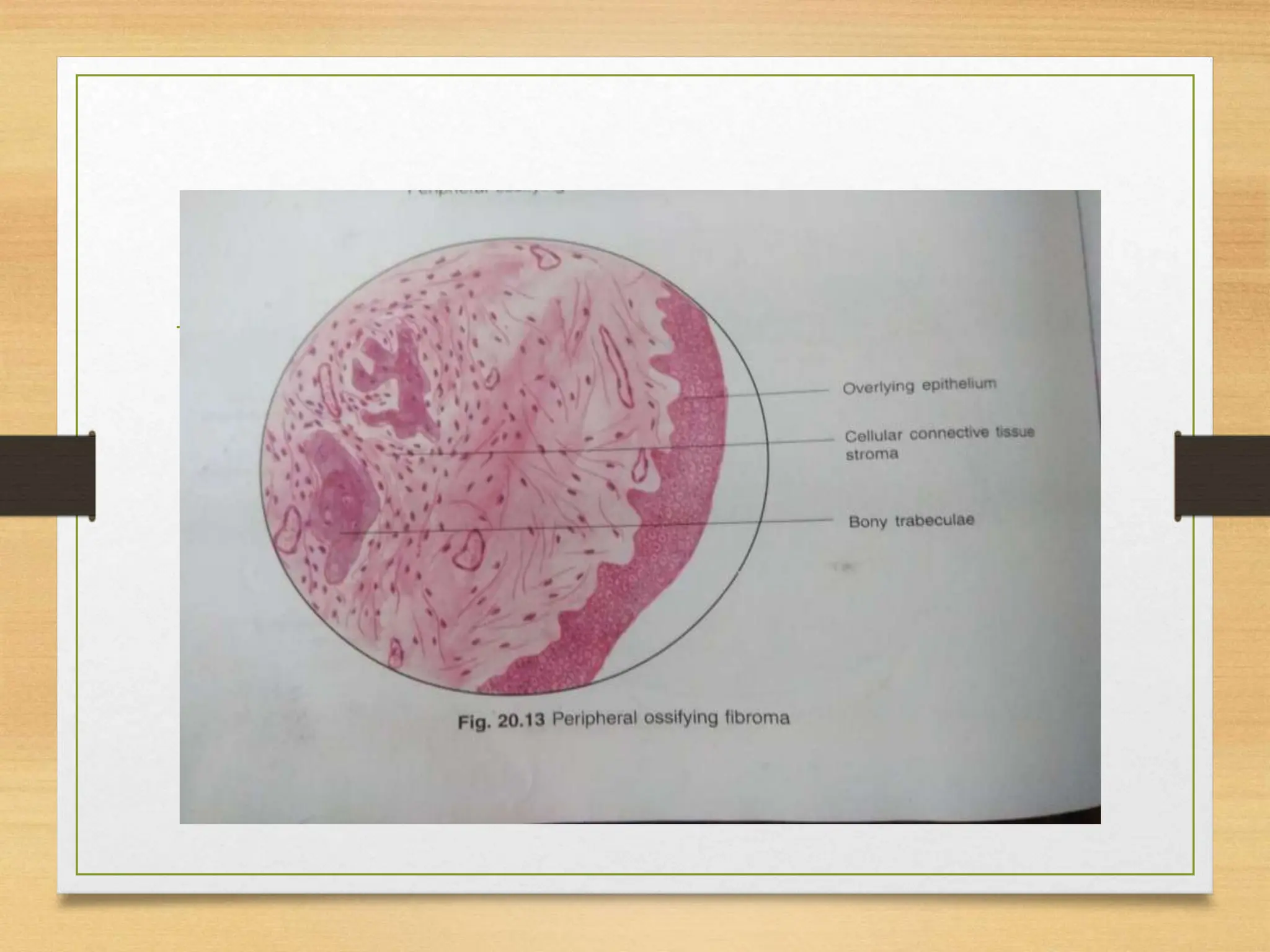 Connective tissue tumors-Benign for 3rd bds.ppt