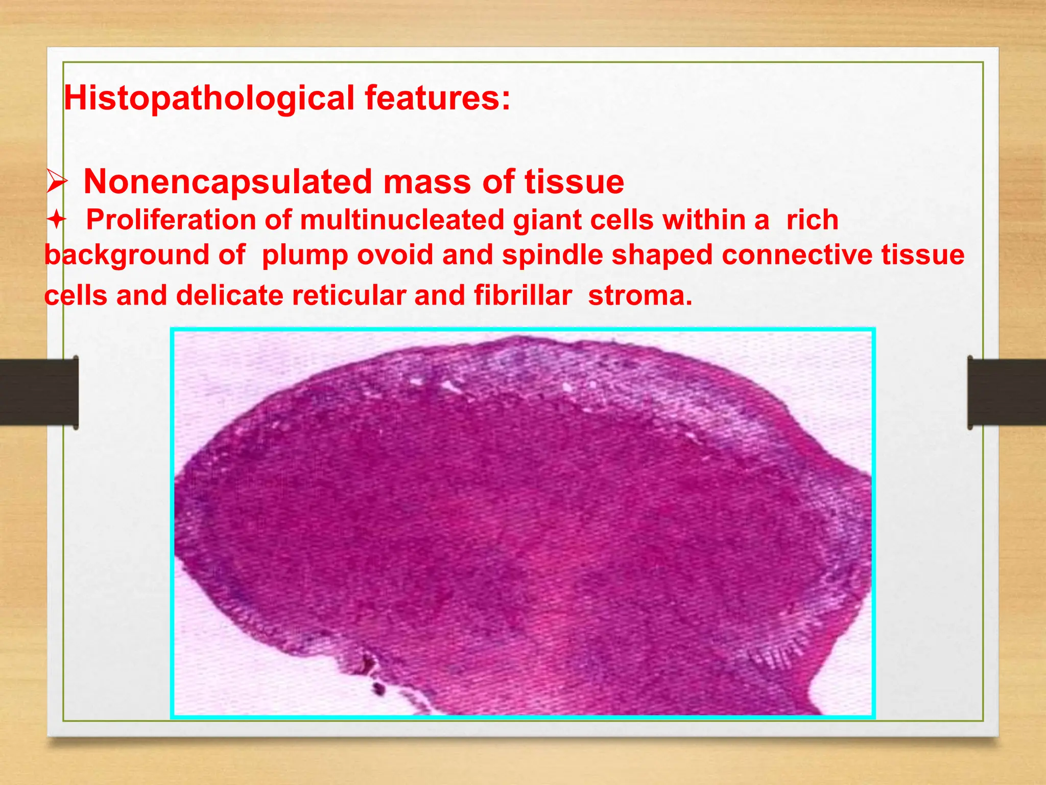 Connective tissue tumors-Benign for 3rd bds.ppt