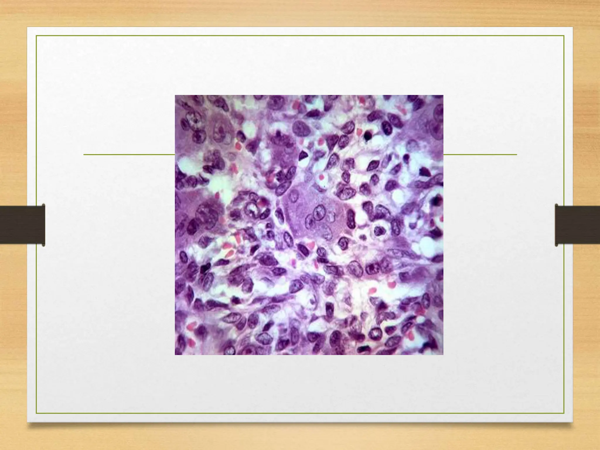 Connective tissue tumors-Benign for 3rd bds.ppt