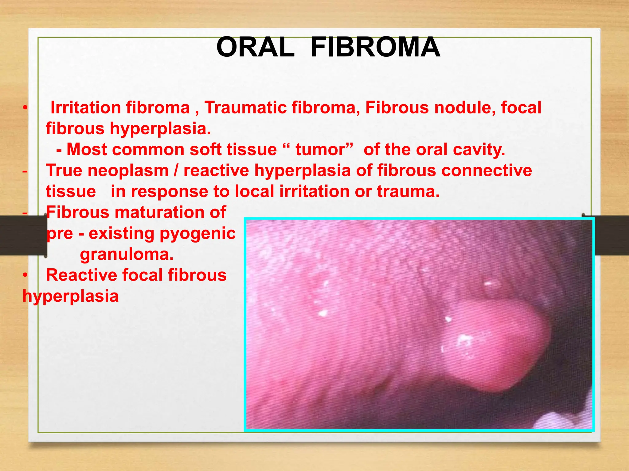 Connective tissue tumors-Benign for 3rd bds.ppt