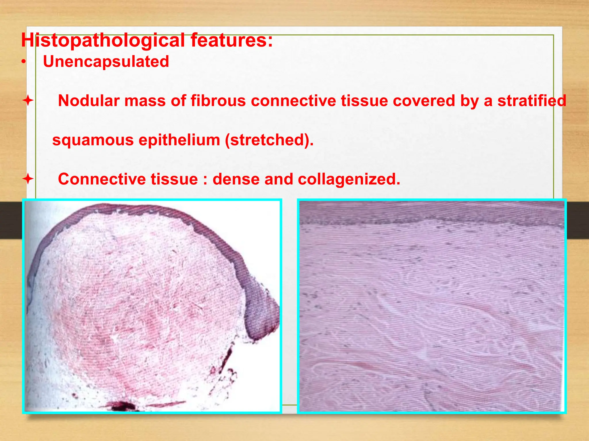 Connective tissue tumors-Benign for 3rd bds.ppt