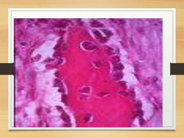 Connective tissue tumors-Benign for 3rd bds.ppt