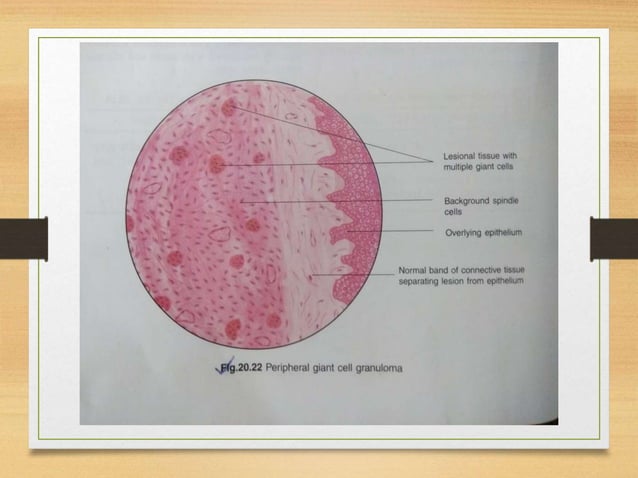 Connective tissue tumors-Benign for 3rd bds.ppt