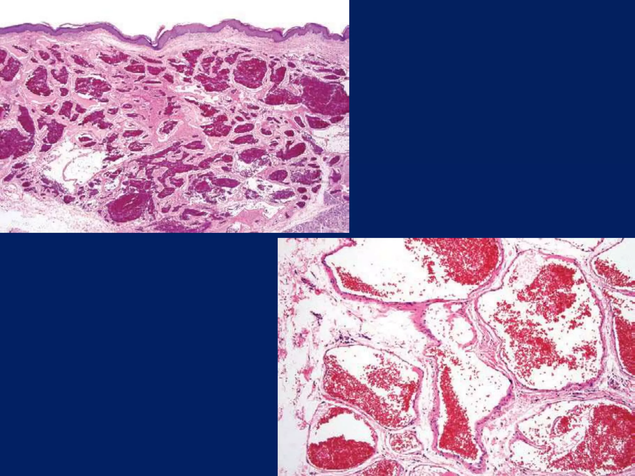 benign and malignant tumors of connective tissue origin | PPTX