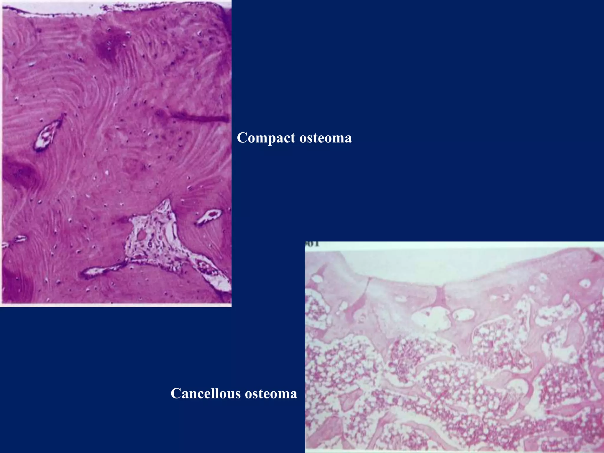 benign and malignant tumors of connective tissue origin | PPTX