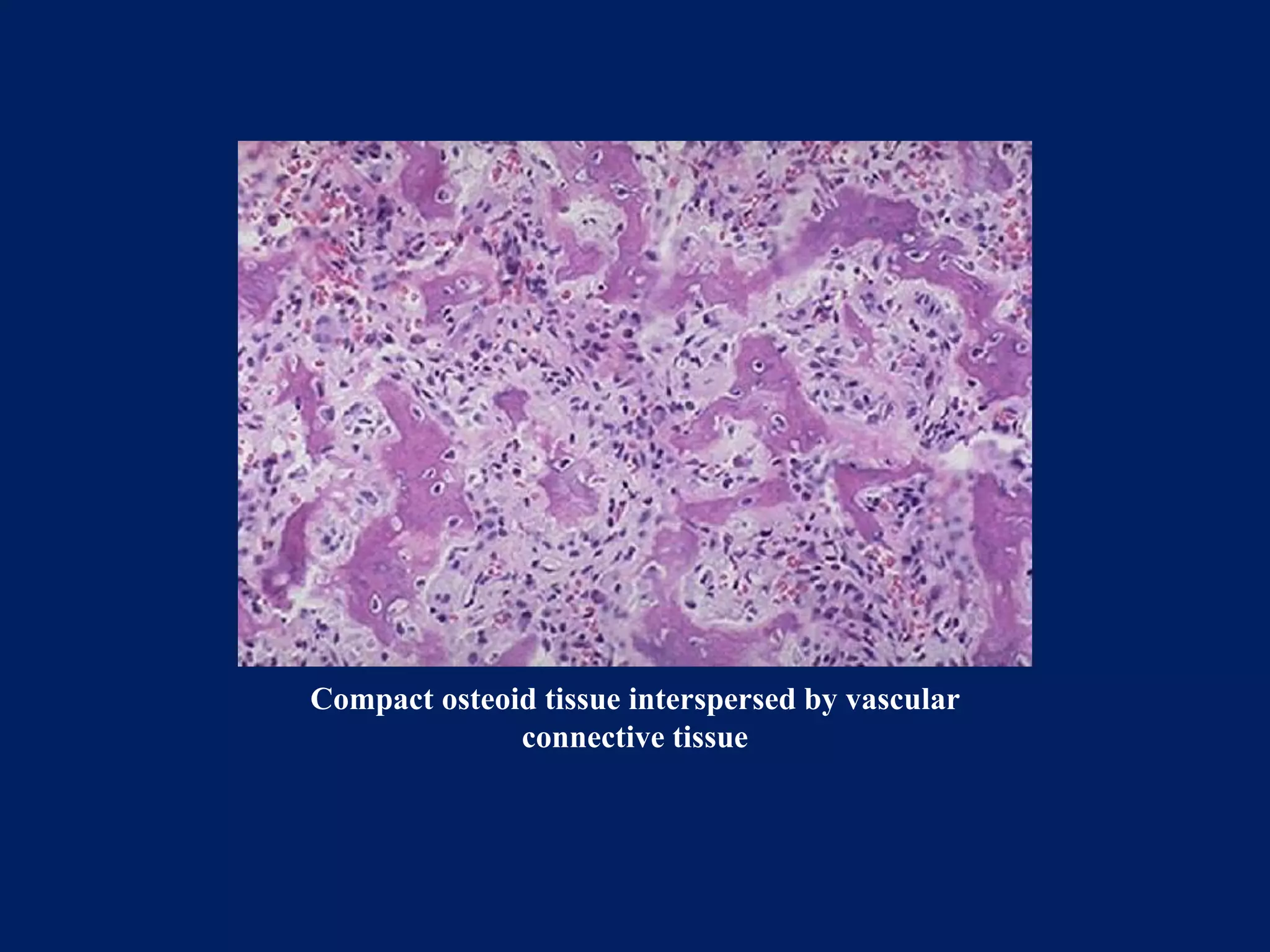 benign and malignant tumors of connective tissue origin | PPTX