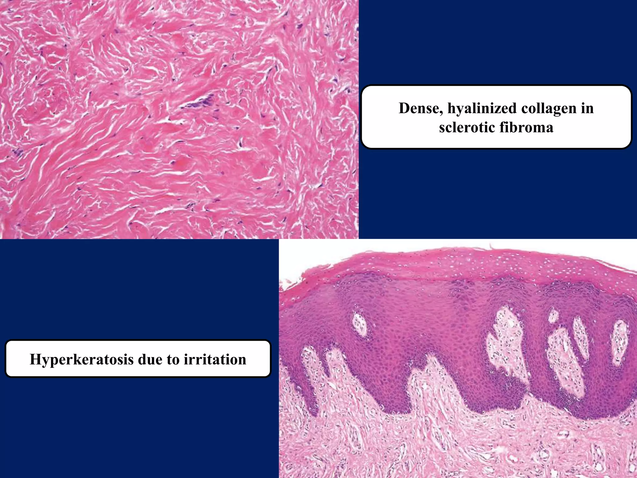 benign and malignant tumors of connective tissue origin | PPTX
