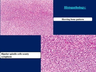 benign and malignant tumors of connective tissue origin | PPTX