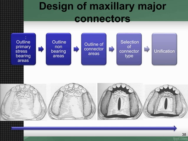 Major Connectors | PPTX | Dental Health | Diseases and Conditions