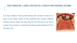 CONNECTORS AND SOLDERS IN FIXED DENTAL PROSTHESIS | PPTX