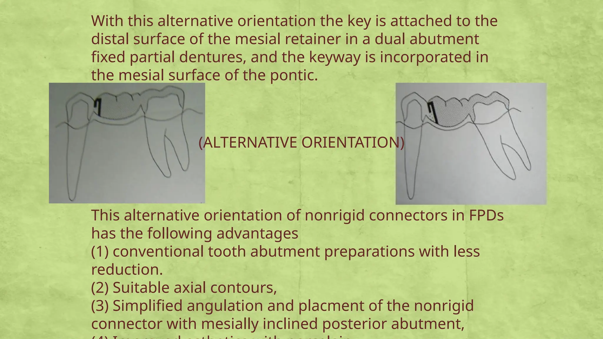 CONNECTORS IN FIXED PARTIAL DENTURE.pptx