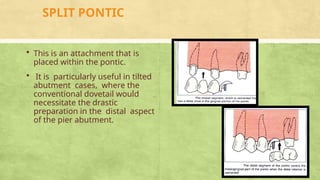 CONNECTORS IN FIXED PARTIAL DENTURE.pptx