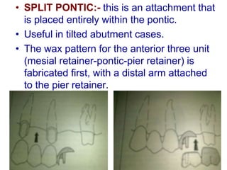 CONNECTORS IN FIXED PARTIAL DENTURE(devesh rathi).ppt