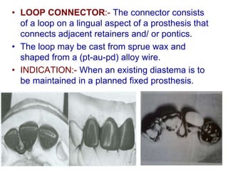 CONNECTORS IN FIXED PARTIAL DENTURE(devesh rathi).ppt