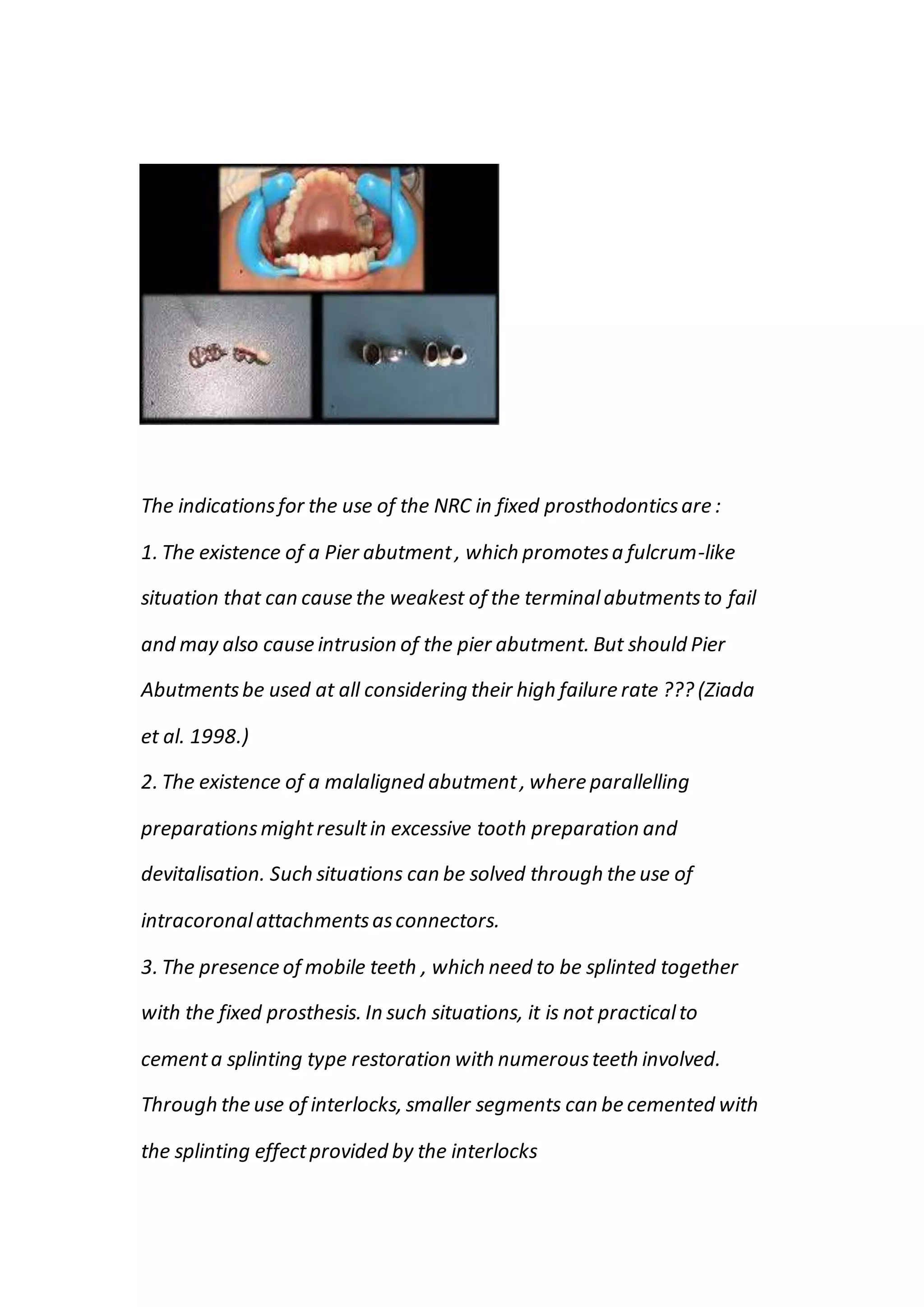 Connectors in fixed prosthodontics | DOCX