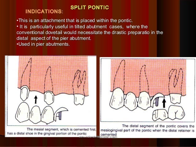 Connectors in fpd/ continued dental education