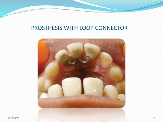 connectors in FPD.pptx | Dental Health | Diseases and Conditions