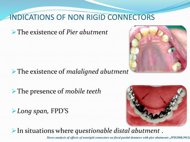 connectors in FPD.pptx | Dental Health | Diseases and Conditions