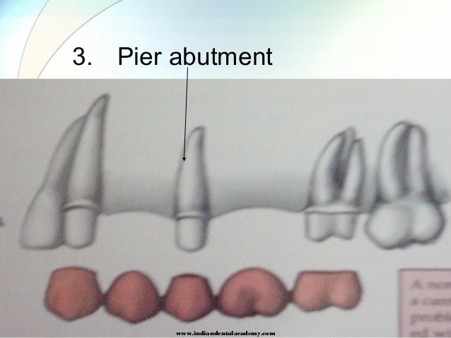 Connectors in fpd / dental continuing education