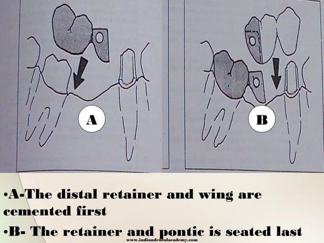 Connectors in fpd 2/ oral surgery courses | PPT | Dental Health ...
