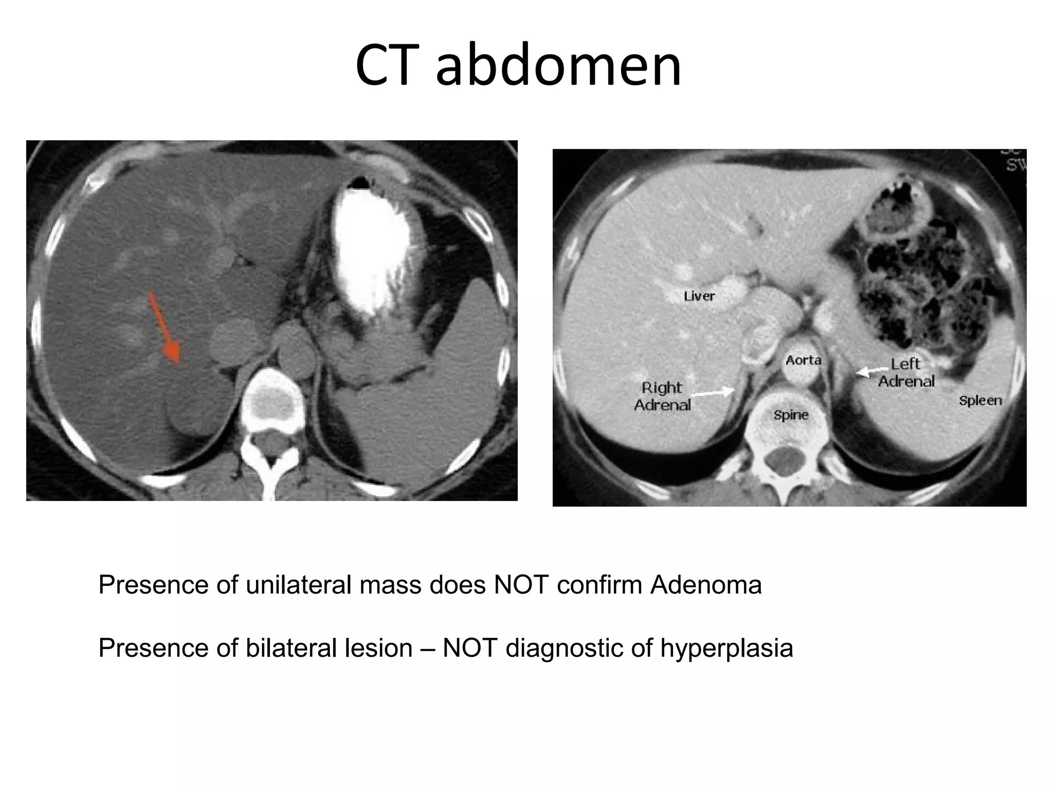 Conn’s syndrome | PPT