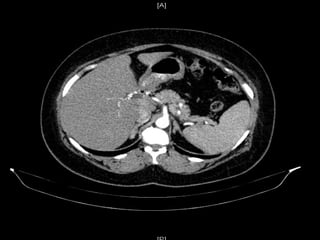 Conn’s syndrome | PPT