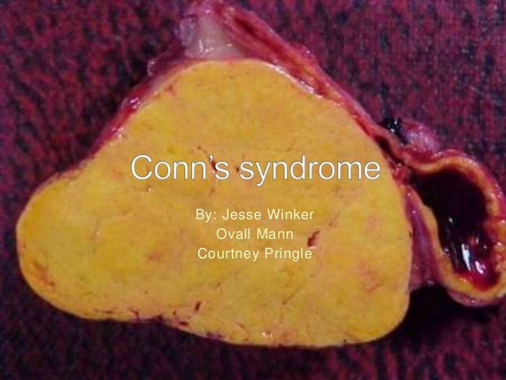 Conn’s syndrome group project