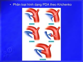 Còn ống động mạch - 2019 - Đại học Y dược TPHCM | PPT