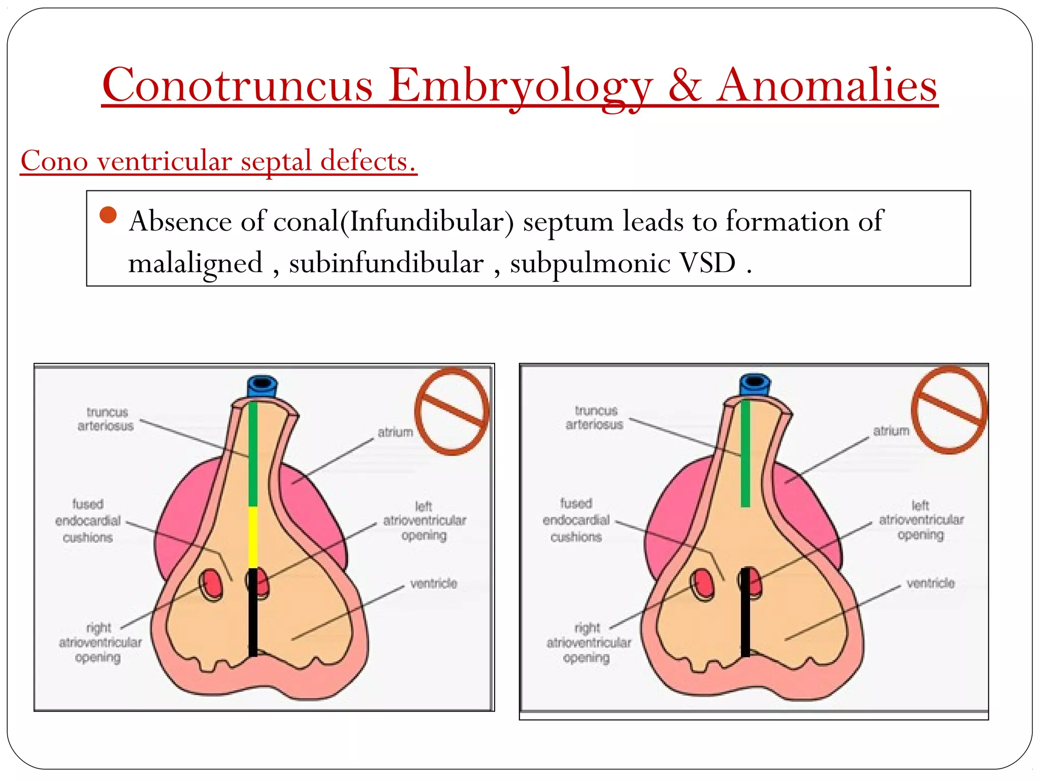 Conotruncal anamolies | PPT
